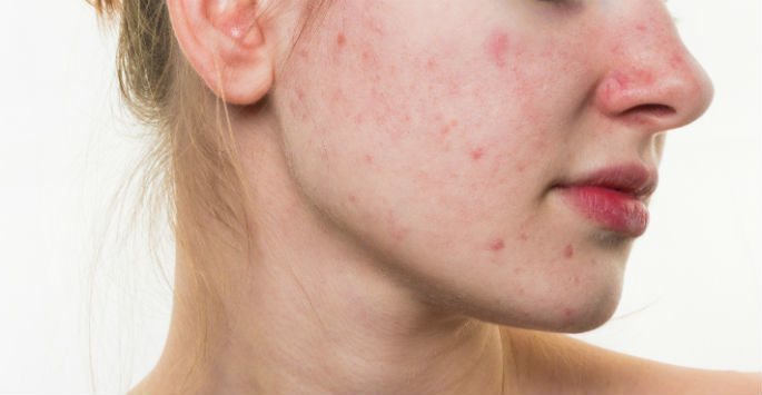 How To Make Acne Less Red LaptrinhX News
